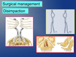 Mid face fracture-Maxillary fracture | PPT