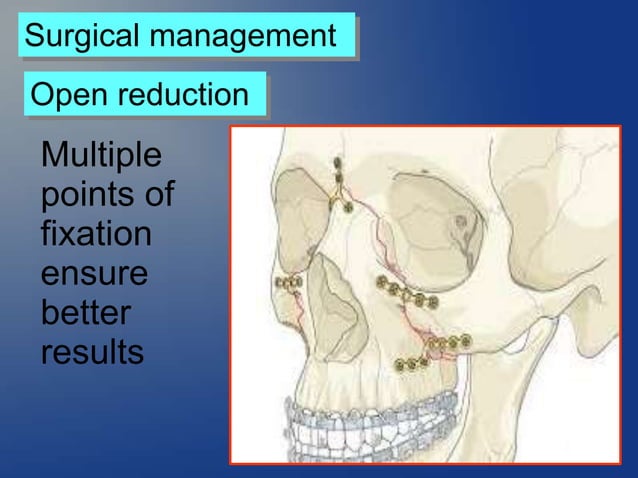 Mid face fracture-Maxillary fracture | PPT