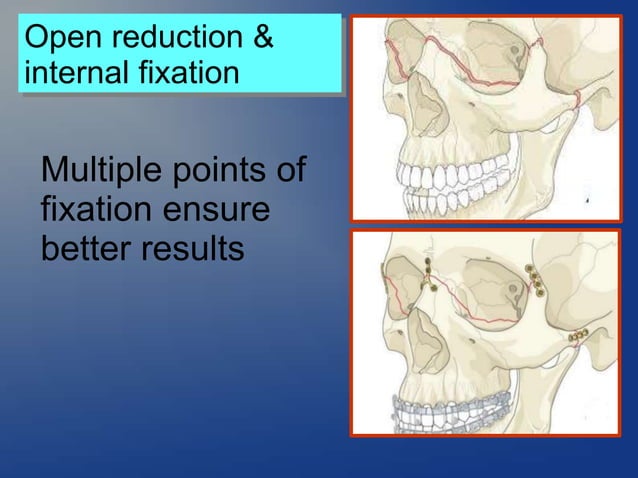 Mid face fracture-Maxillary fracture | PPT