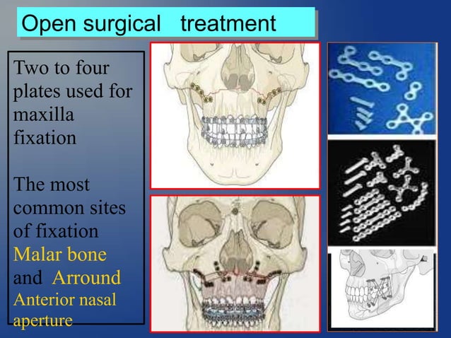 Mid face fracture-Maxillary fracture | PPT