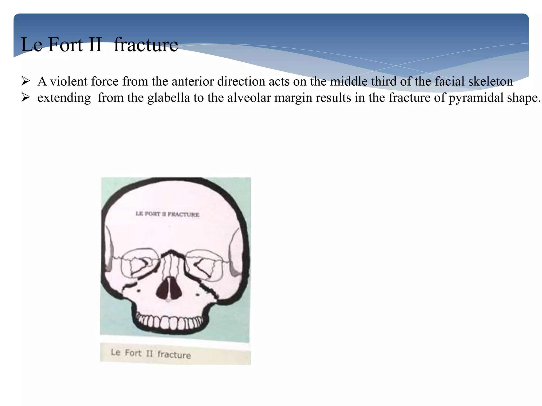 MAXILLARY FRACTURE.pptx