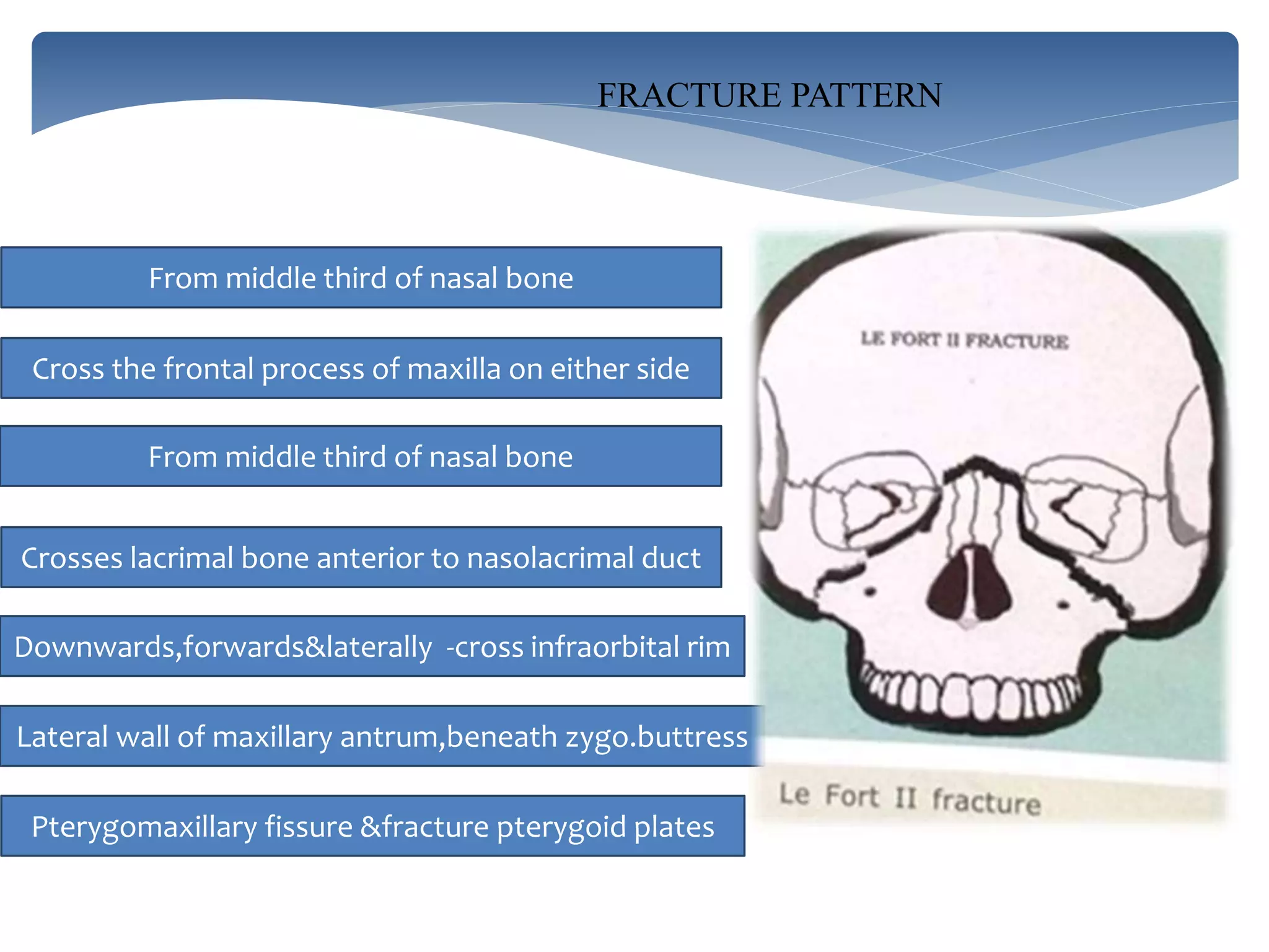 MAXILLARY FRACTURE.pptx
