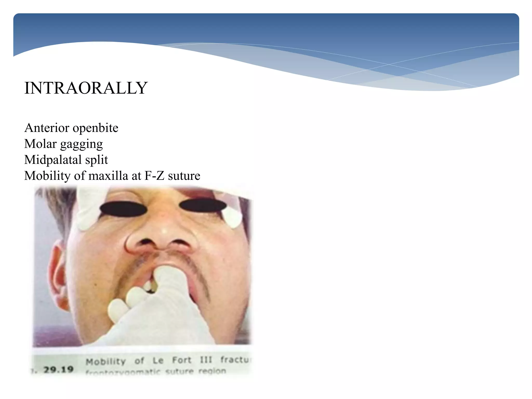 MAXILLARY FRACTURE.pptx