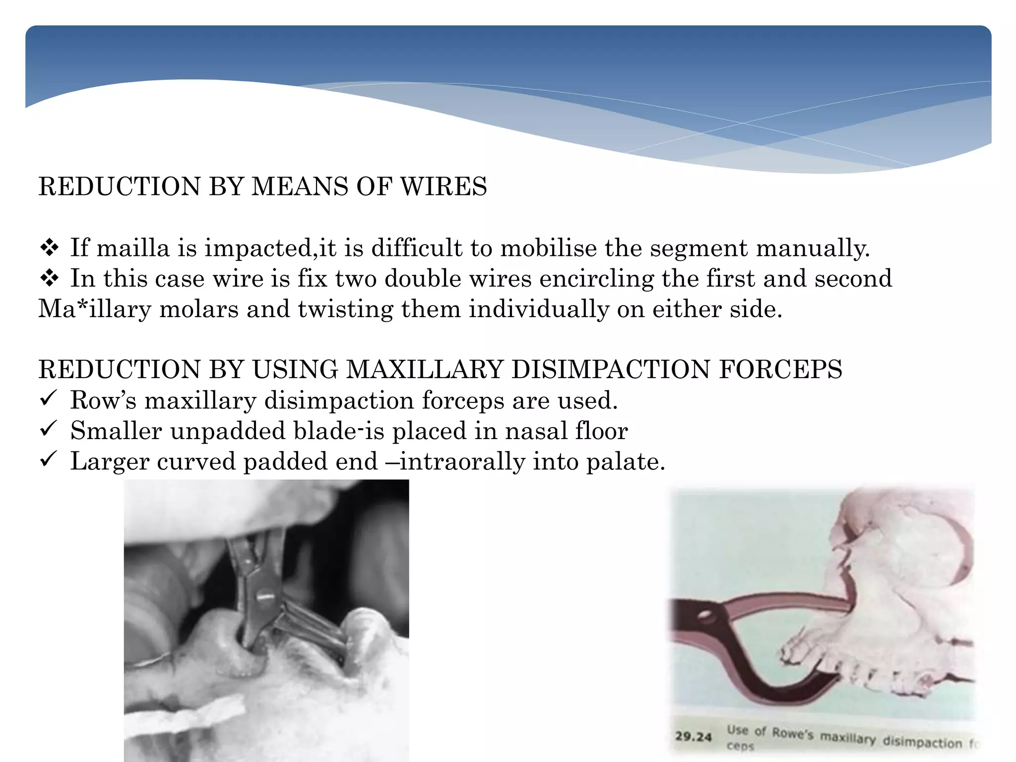 MAXILLARY FRACTURE.pptx