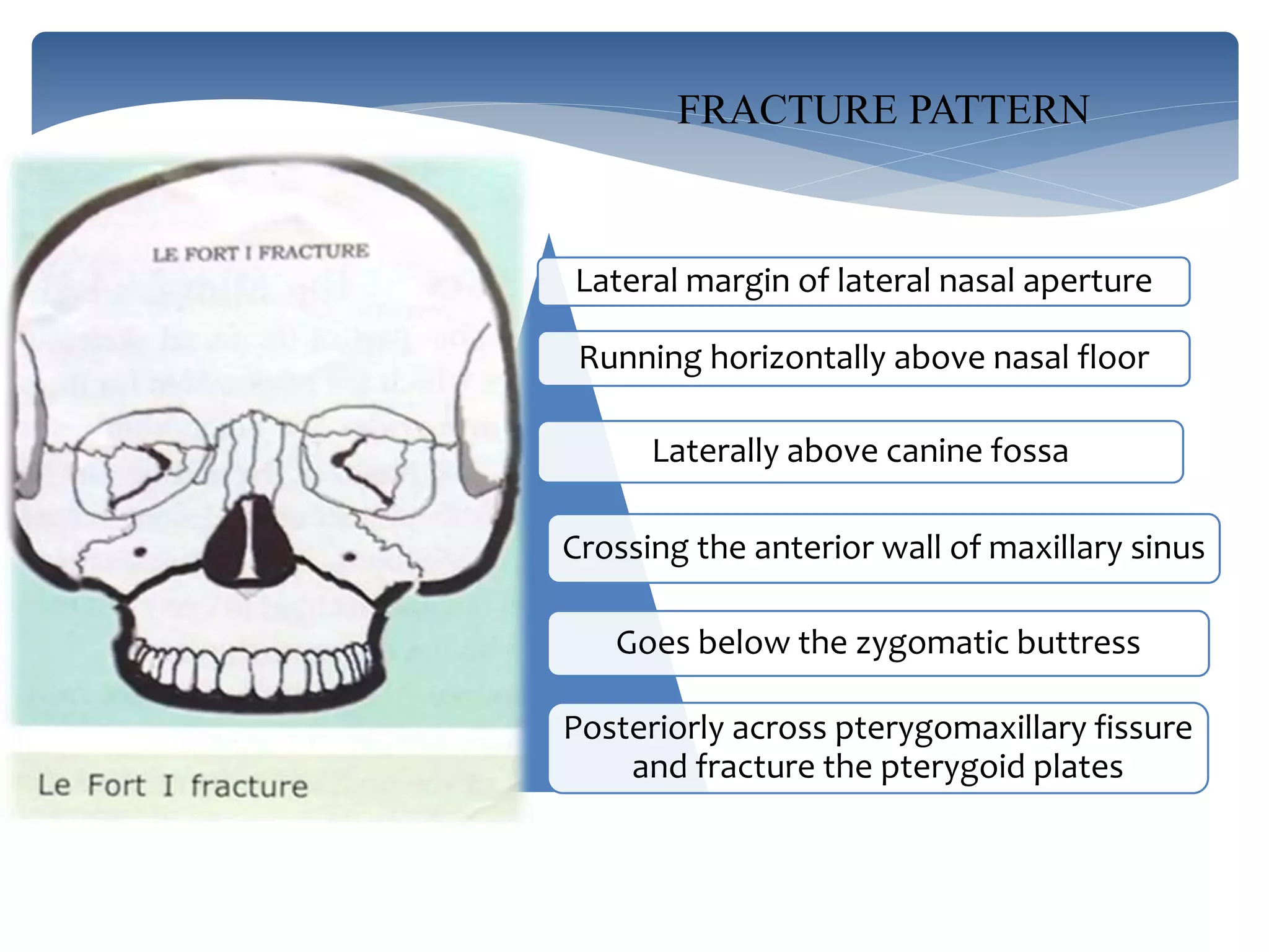 MAXILLARY FRACTURE.pptx