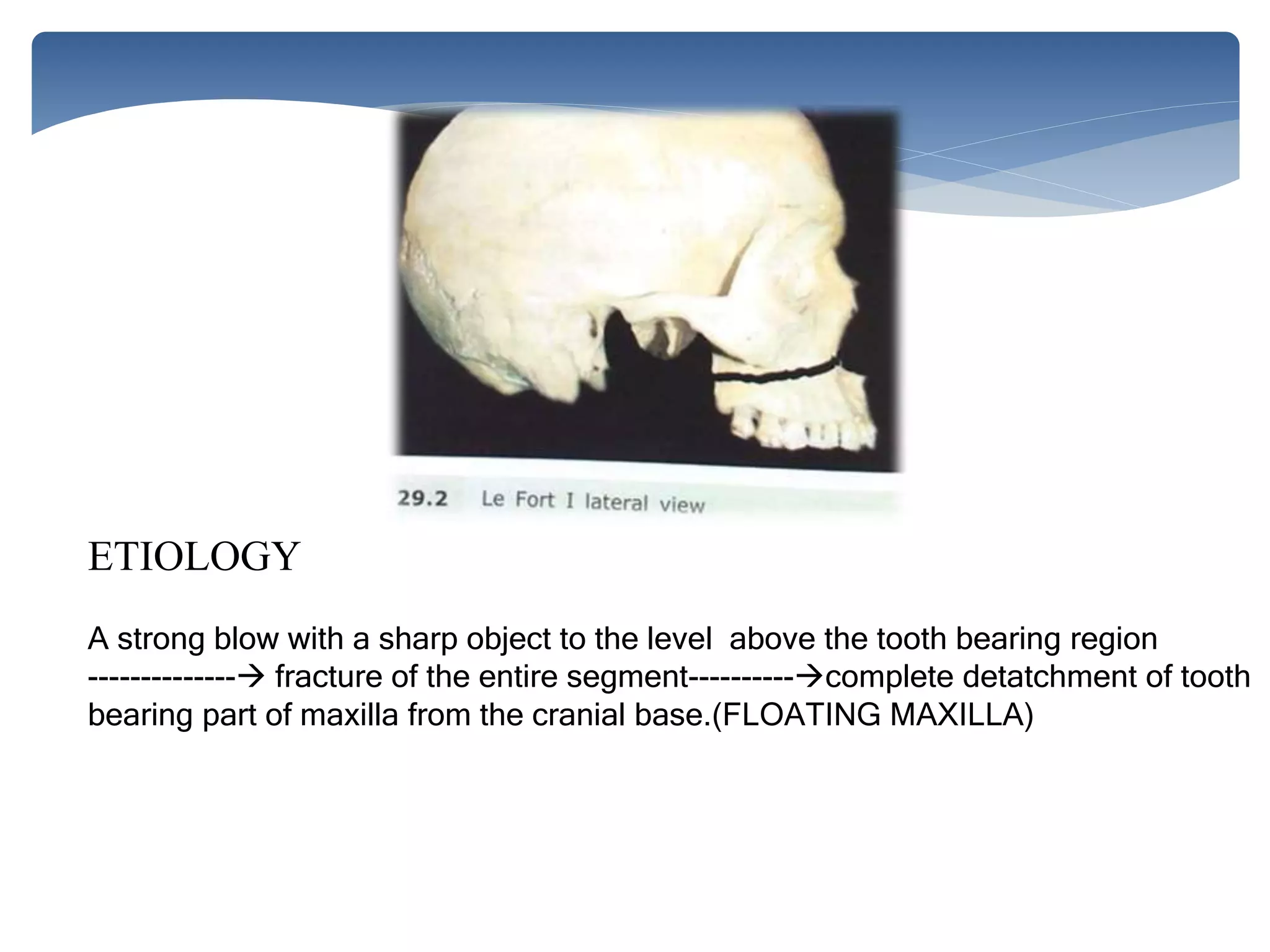 MAXILLARY FRACTURE.pptx