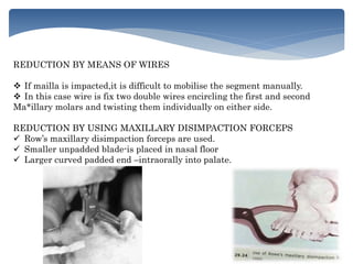 MAXILLARY FRACTURE.pptx