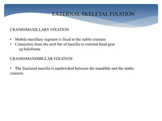 MAXILLARY FRACTURE.pptx
