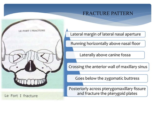 MAXILLARY FRACTURE.pptx | Death, Injury, or Military Conflict ...