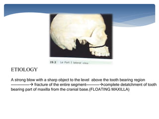 MAXILLARY FRACTURE.pptx