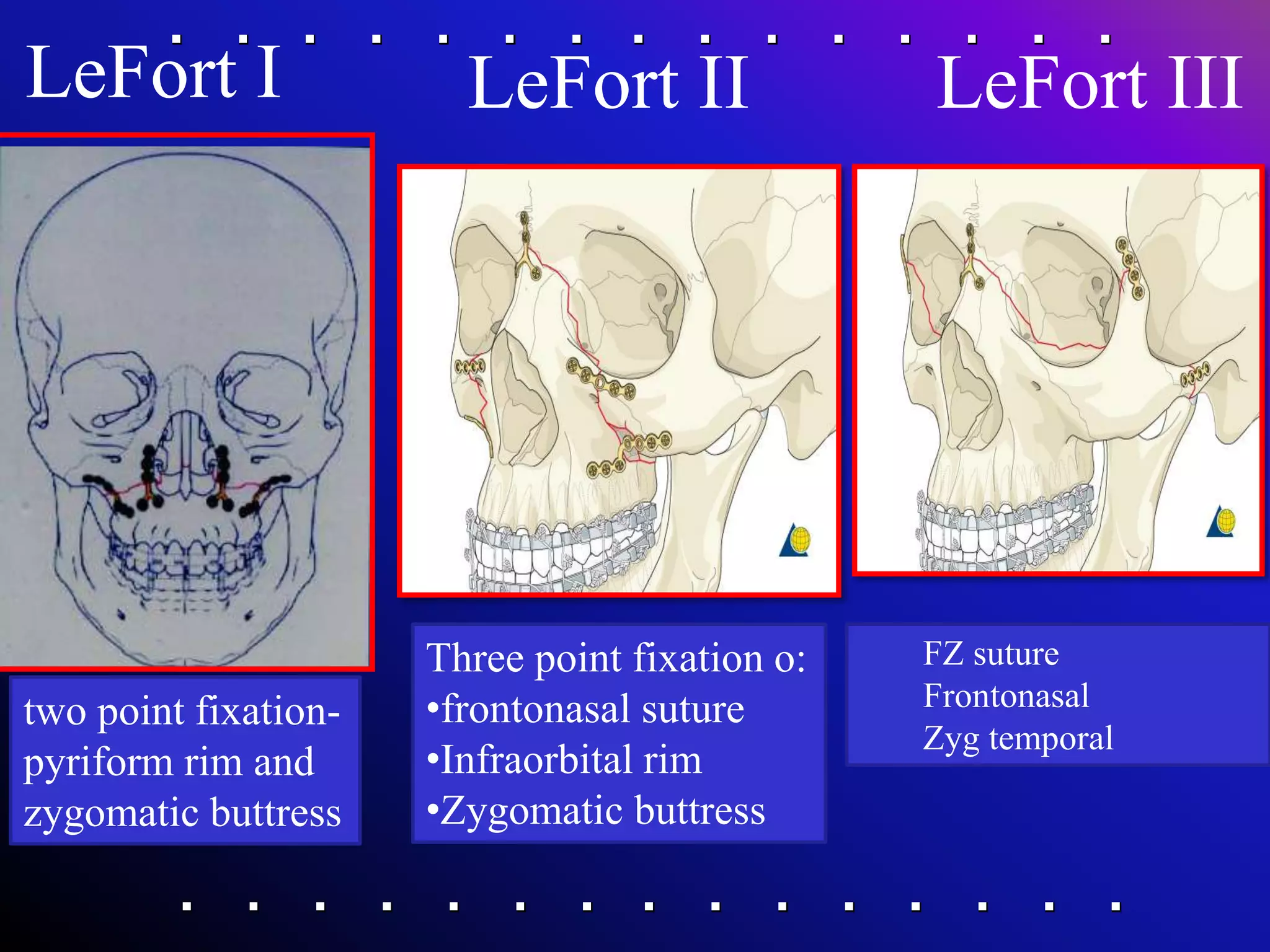 maxillary fractures.pptx