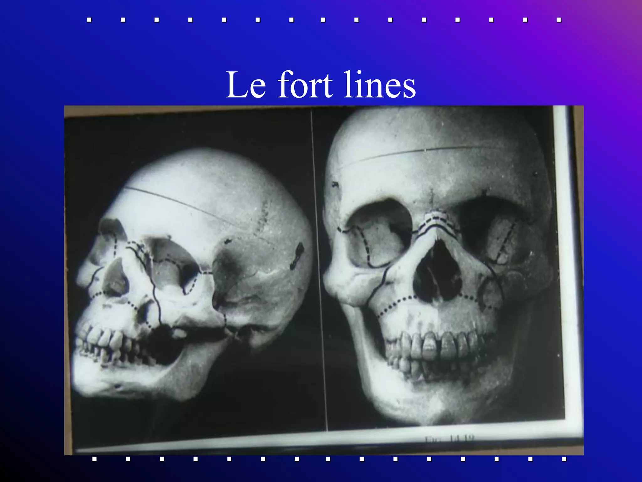 maxillary fractures.pptx