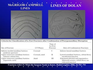 maxillary fractures.pptx