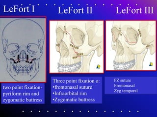 maxillary fractures.pptx