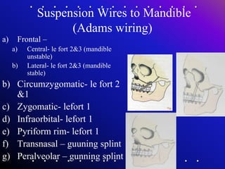 maxillary fractures.pptx
