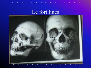 maxillary fractures.pptx