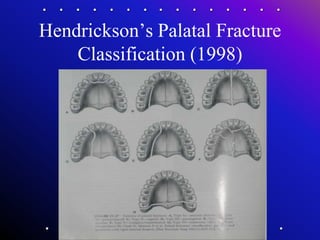 maxillary fractures.pptx