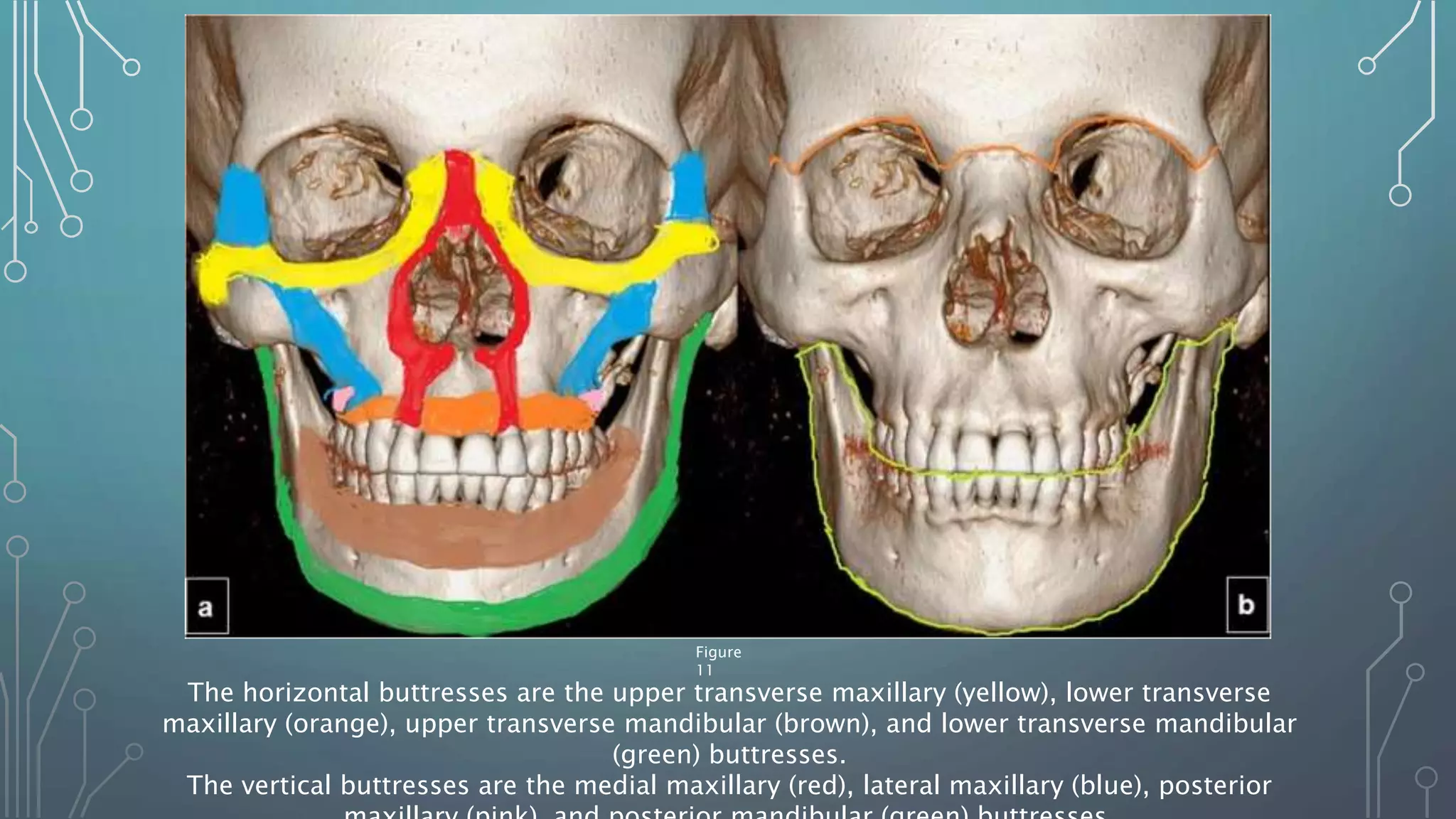 Maxillary fractures | PPTX