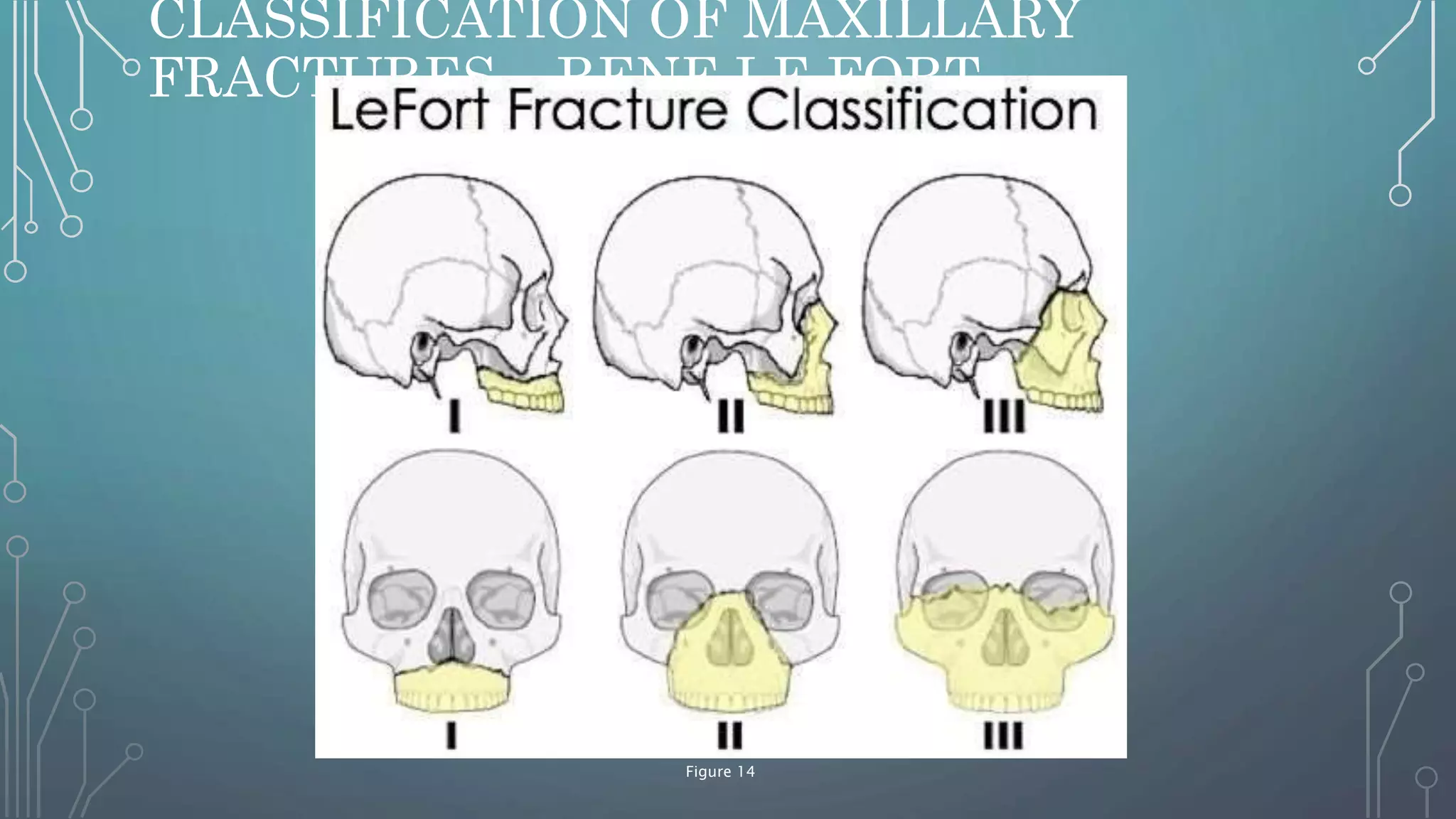 Maxillary fractures | PPTX