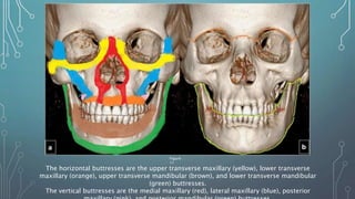 Maxillary fractures | PPTX