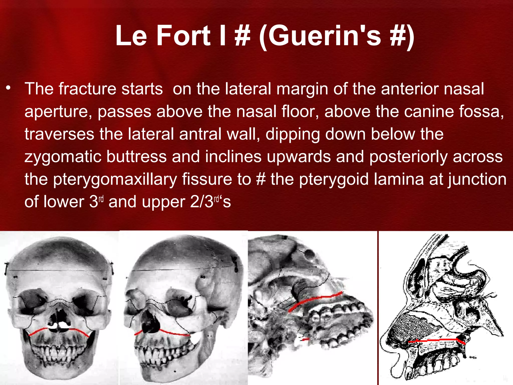 Maxillary fractures ih | PPT