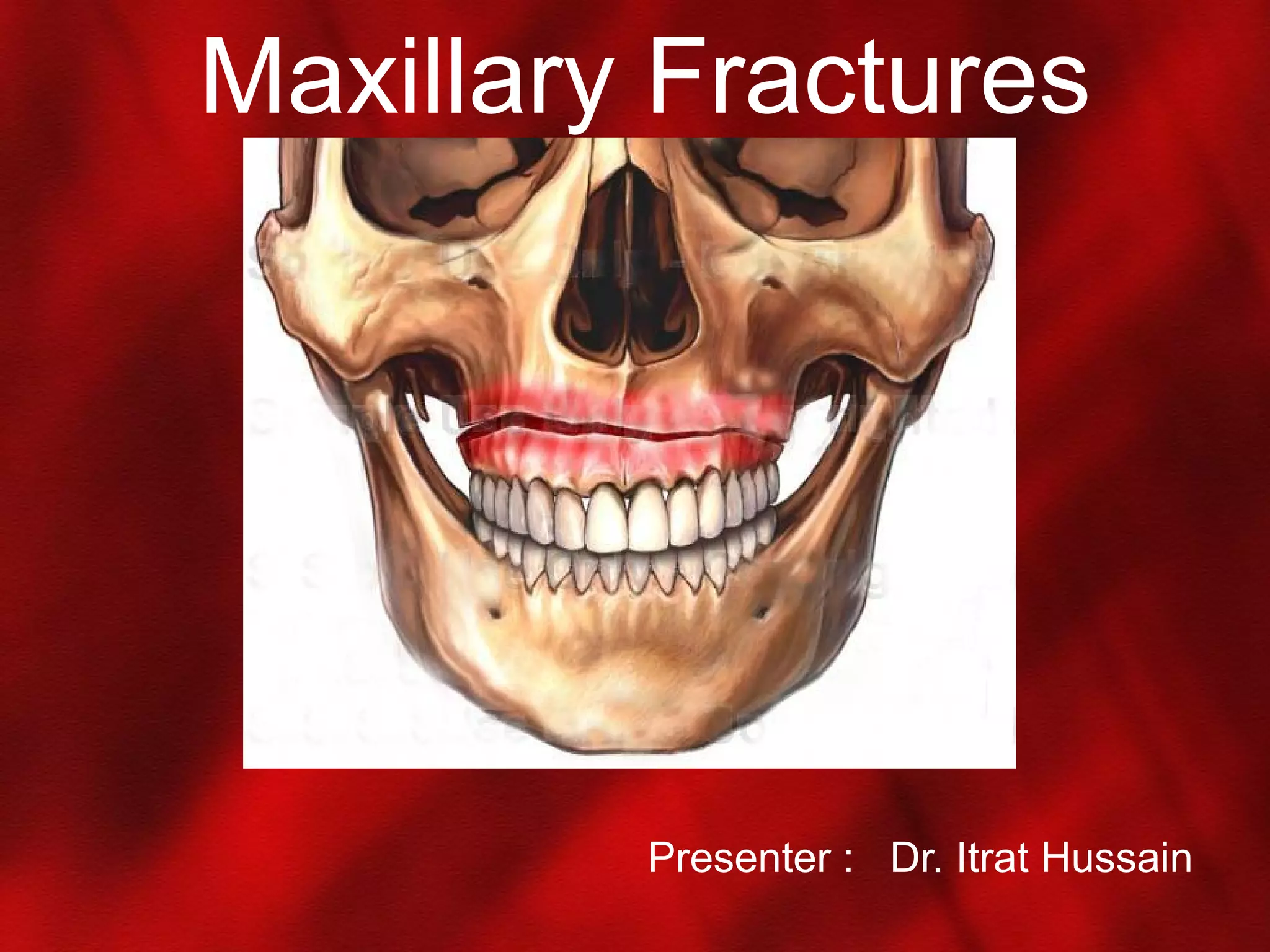 Maxillary fractures ih | PPT
