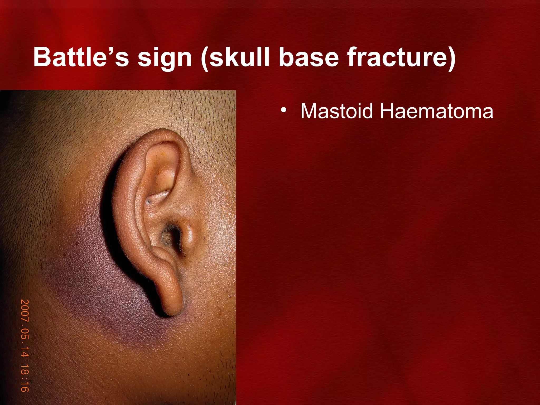 Maxillary fractures ih | PPT