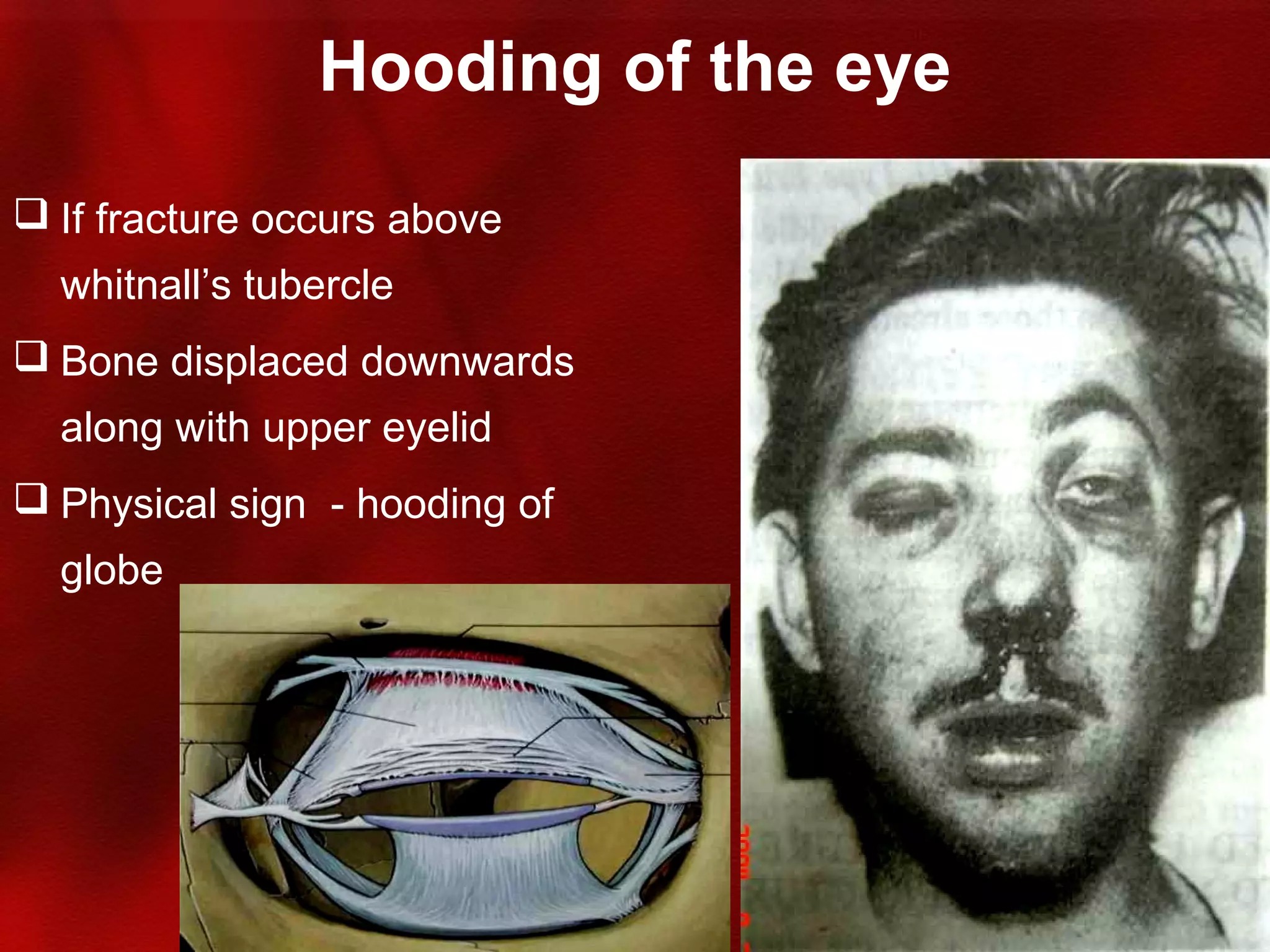 Maxillary fractures ih | PPT