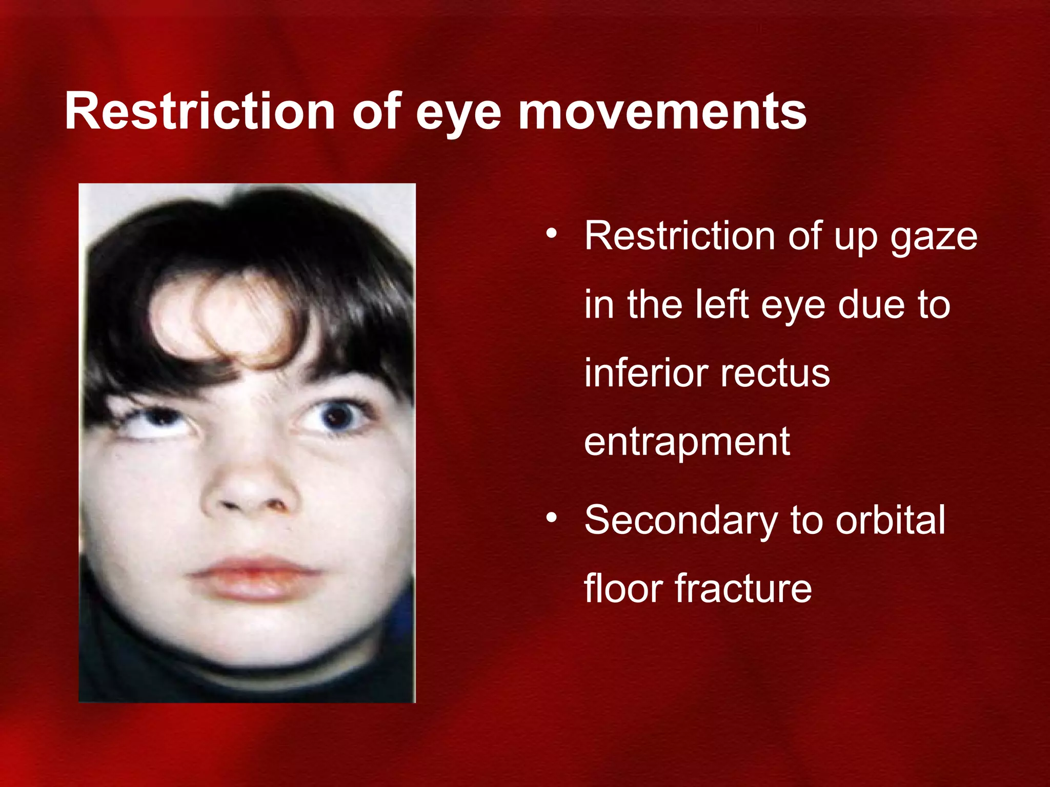 Maxillary fractures ih | PPT