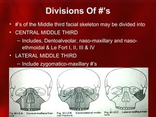 Maxillary fractures ih | PPT