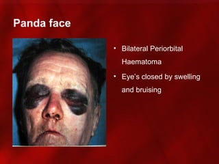 Maxillary fractures ih | PPT