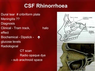 Cribriform Plate Fracture