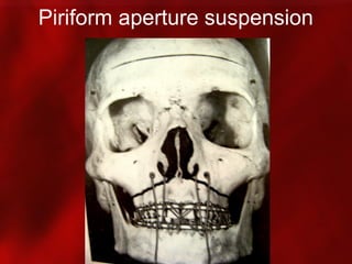 Maxillary fractures presentation ih | PPT | Bone and Joint Conditions ...