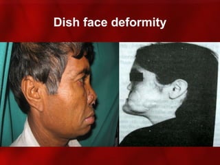 Maxillary fractures presentation ih | PPT