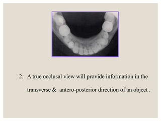 Maxillary impacted canine management | PPTX