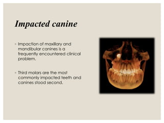 Maxillary impacted canine management | PPTX
