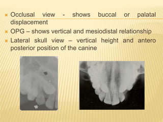 Maxillary impactions | PPTX