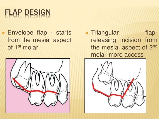 Maxillary impactions