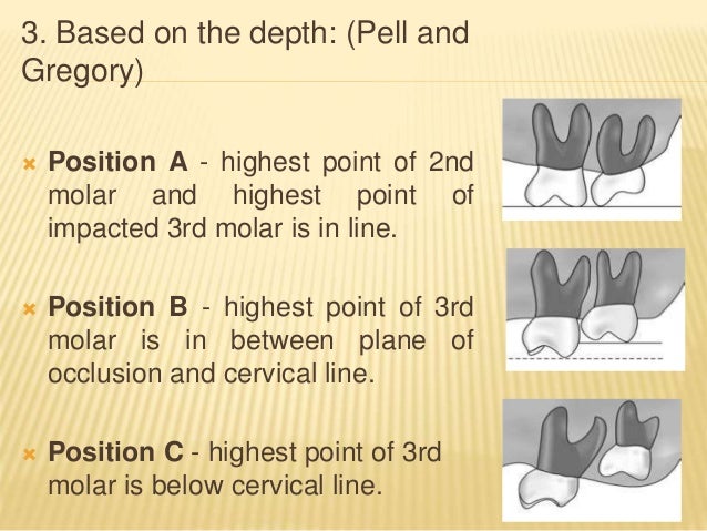 Maxillary impactions