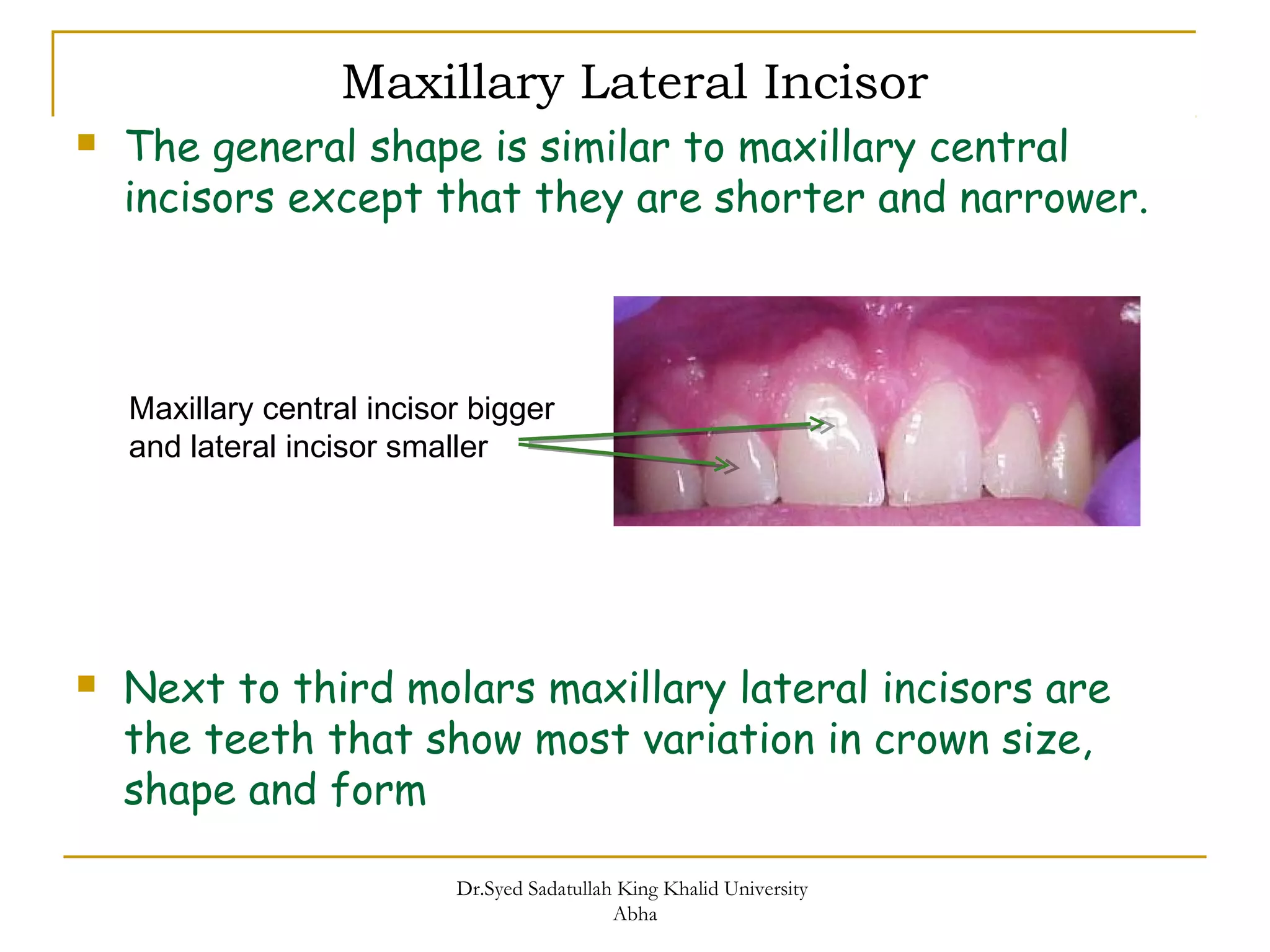 morphology of Maxillary central and lateral incisors teeth | PPT