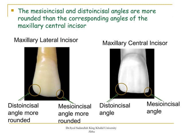morphology of Maxillary central and lateral incisors teeth | PPT ...