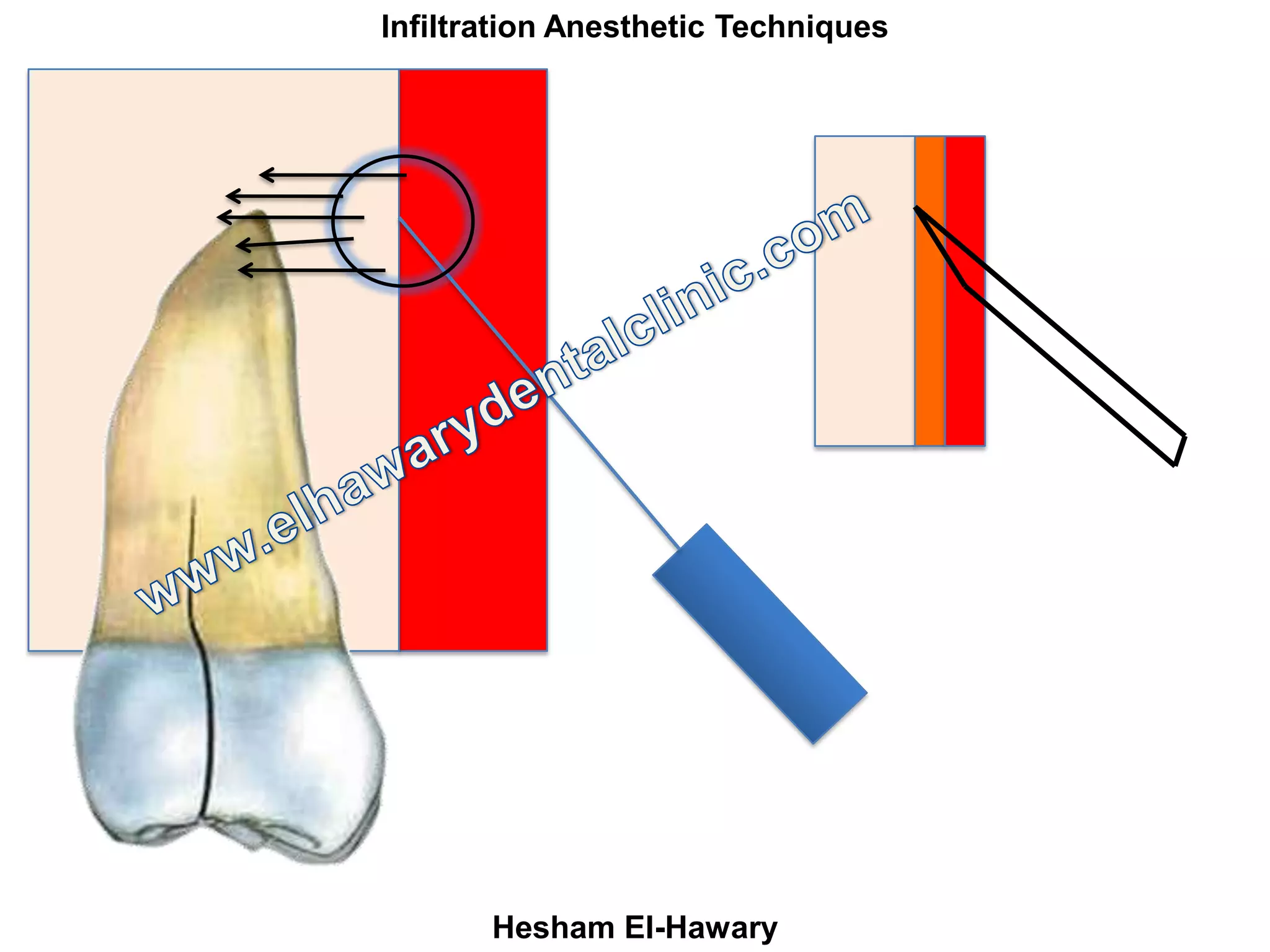 Maxillary infiltration anesthetic techniques (with photos) | PPTX