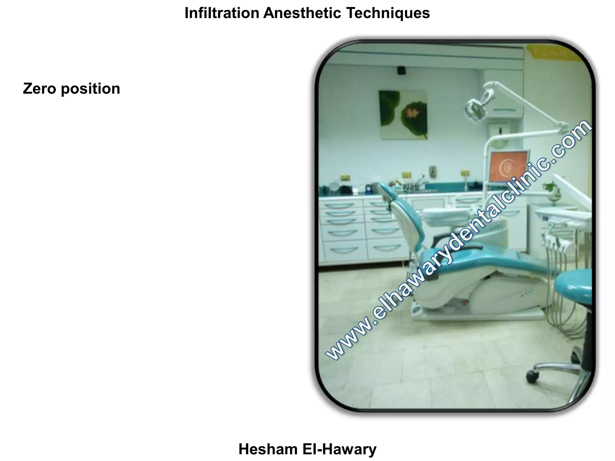 Maxillary infiltration anesthetic techniques (with photos) | PPTX ...