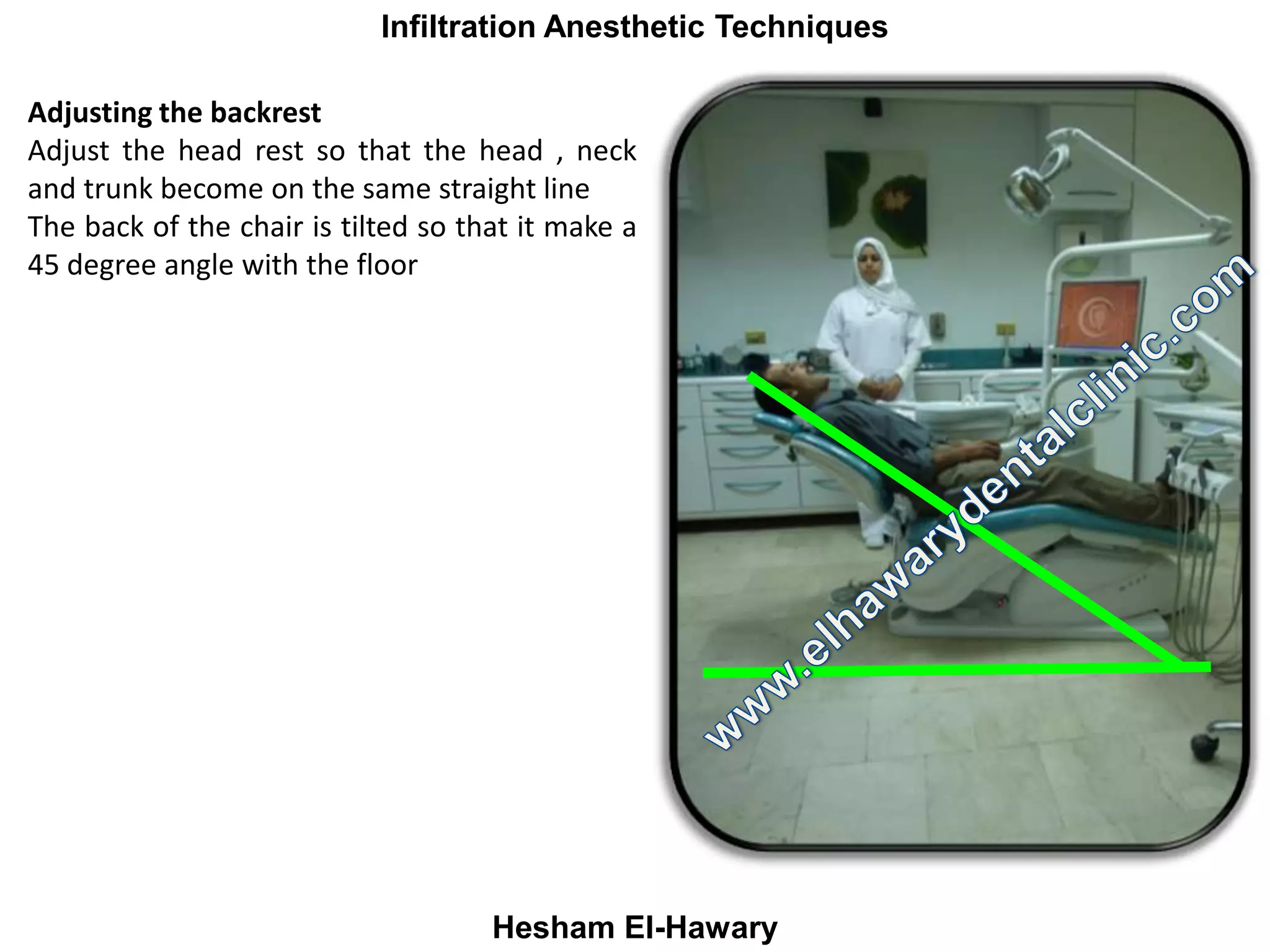 Maxillary infiltration anesthetic techniques (with photos) | PPTX