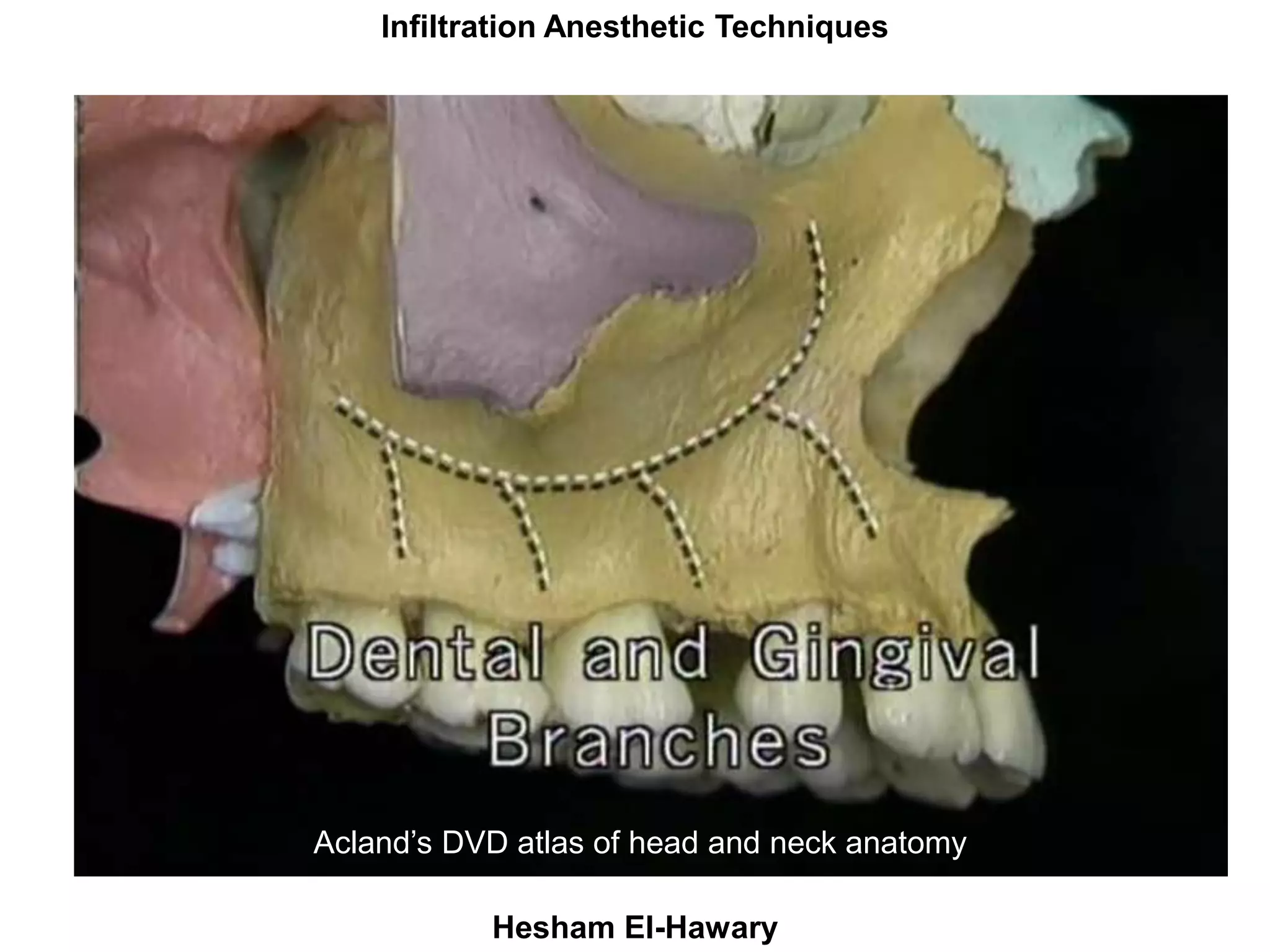 Maxillary infiltration anesthetic techniques (with photos) | PPTX