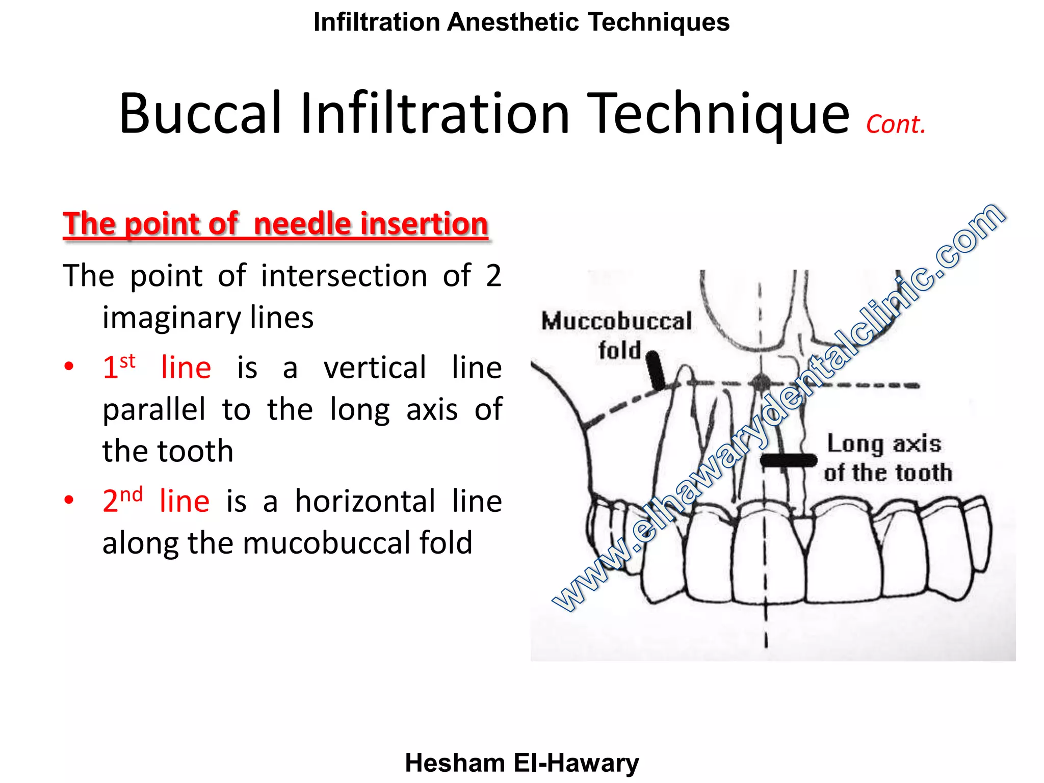 Maxillary infiltration anesthetic techniques (with photos) | PPTX