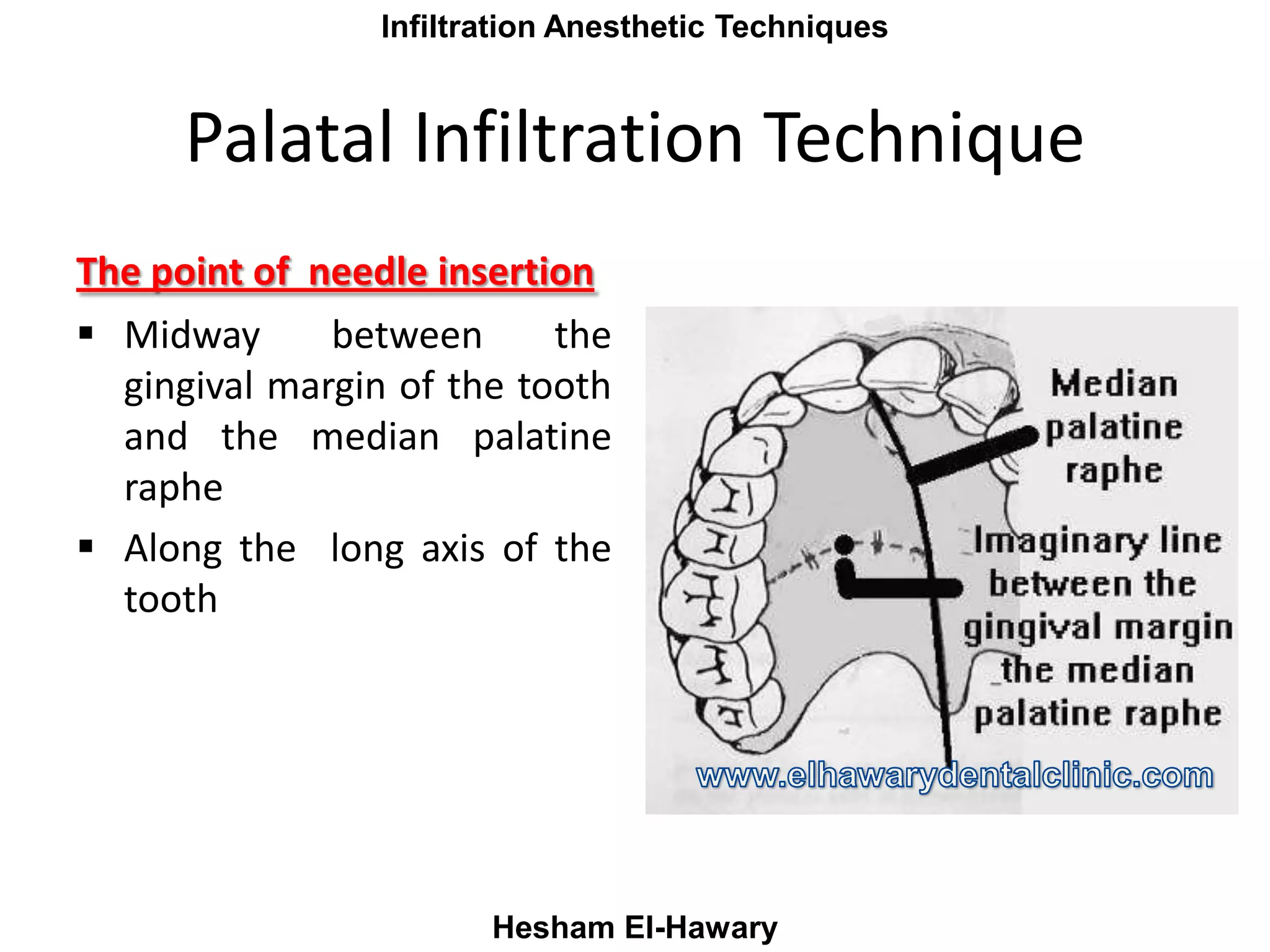Maxillary infiltration anesthetic techniques (with photos) | PPTX