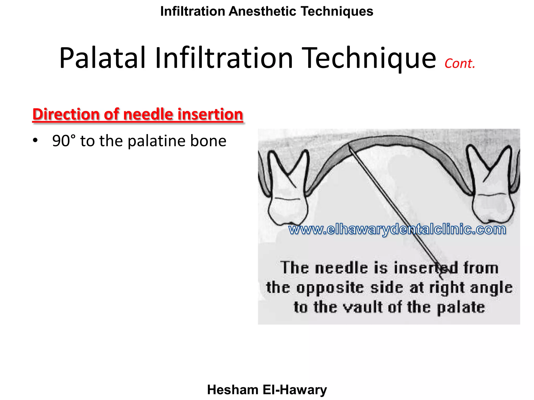 Maxillary infiltration anesthetic techniques (with photos) | PPTX