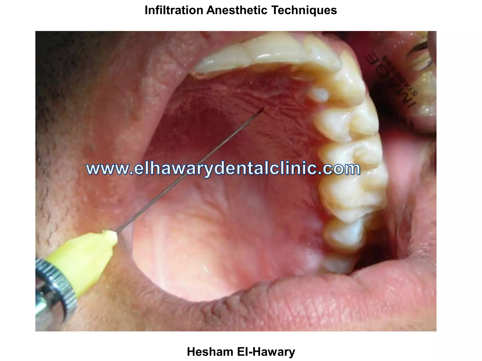 Maxillary infiltration anesthetic techniques (with photos) | PPTX
