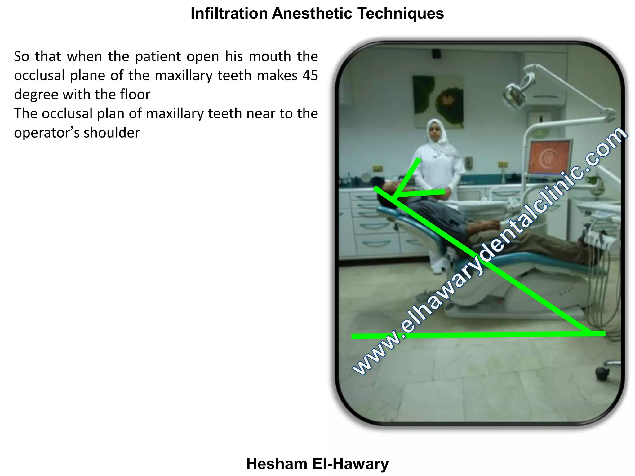 Maxillary infiltration anesthetic techniques (with photos)